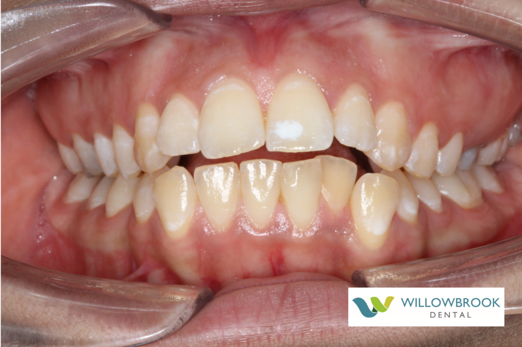 Treatment Gallery - Willowbrook Dental