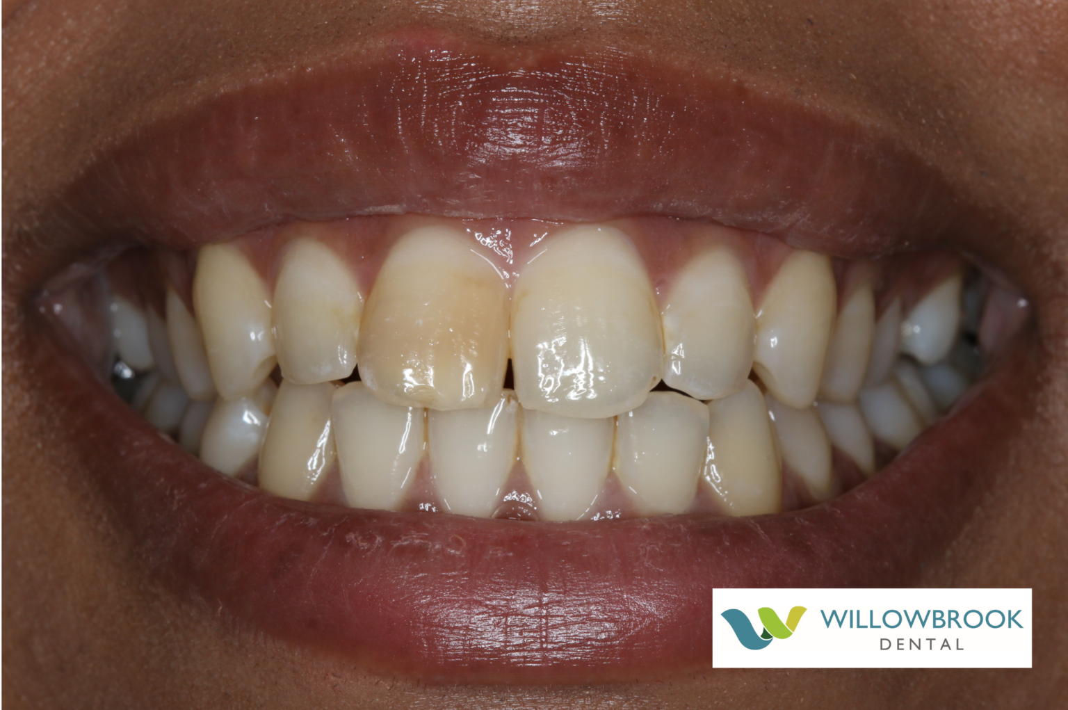 Treatment Gallery - Willowbrook Dental